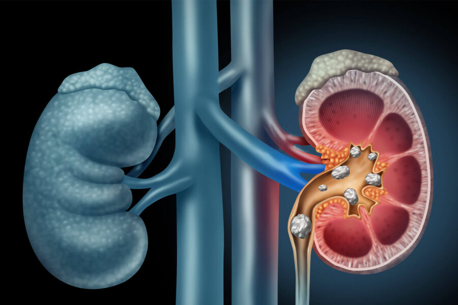 What To Expect: Kidney Stone Surgery Recovery Time Explained