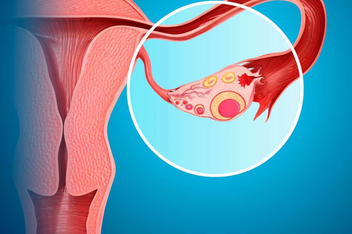 Best Ovarian Cyst Symptoms Vs Pregnancy: Tell The Difference